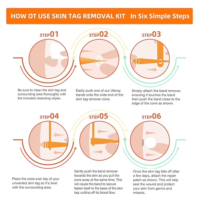 Painless Safe Skin Tag Remove Device Kit Micro Tags Size (2mm to 4mm ...